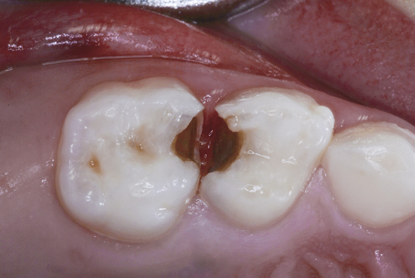 Dental Caries Molar
