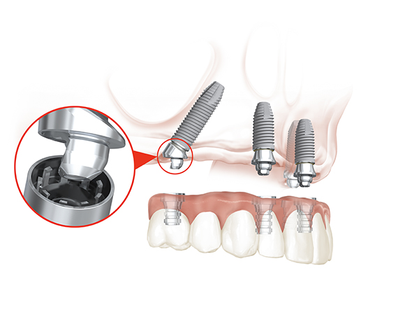 Nobel Biocare’s Multi-unit Abutment Plus | June 2017 | Inside Dentistry