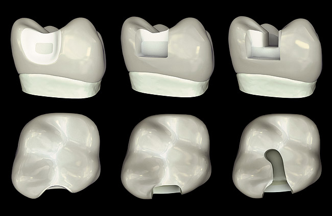 The Injection-Molded Technique for Strong, Esthetic Class II ...