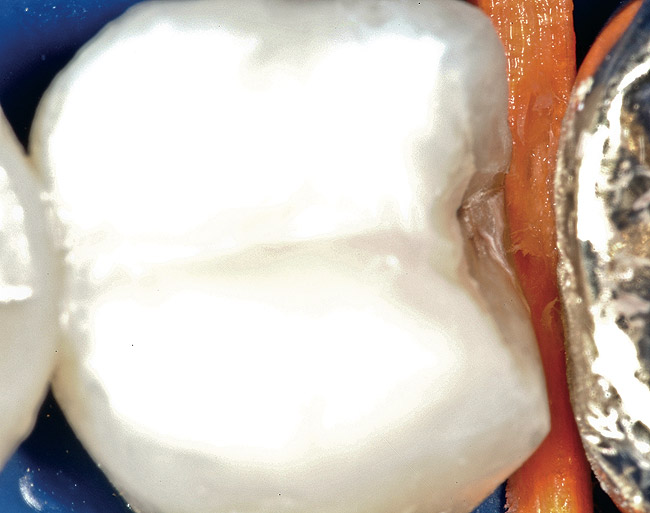 Class Ii Composite Slot Preparation - newfast