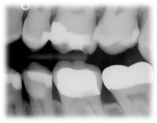 Class II Posterior Composite: Reproducing the Durability | July 2017 ...