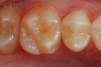 Low-Shrink Composite With Giomer Chemistry Creates Predictable and ...