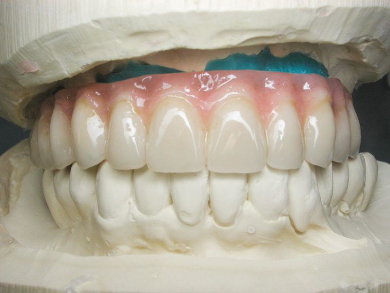 The Screwless Fixed Restorative System: Laboratory Perspective ...
