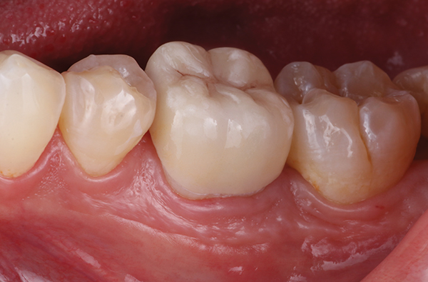 Zirconia Crowns Preparation