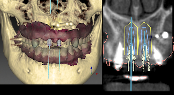 Temporary Shell Proof-of-Concept Technique: Digital-Assisted Workflow ...