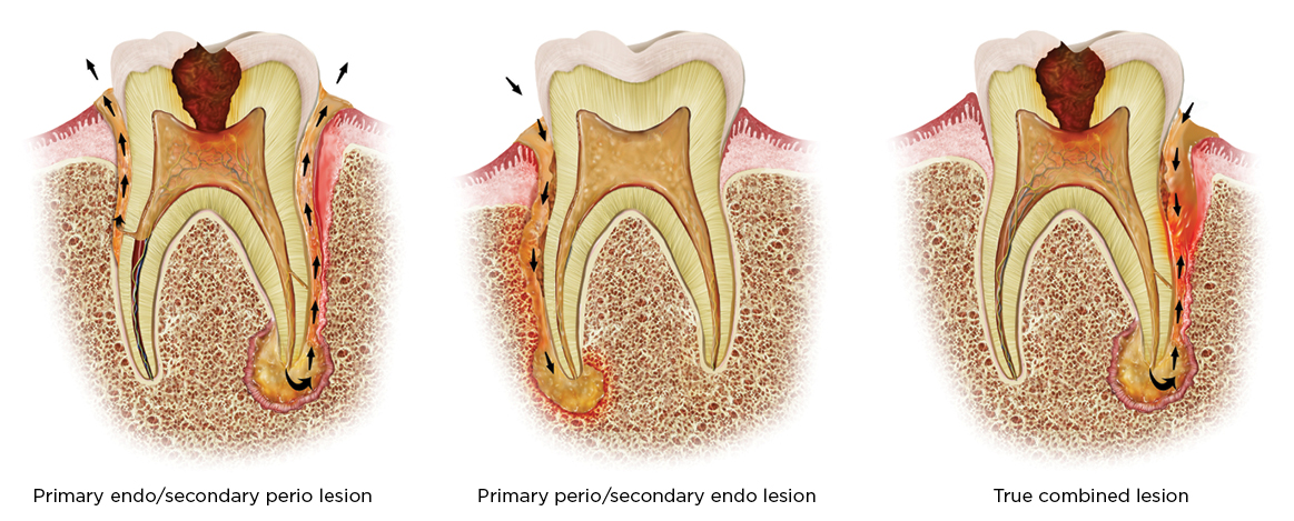 Understanding Periodontal-Endodontic Infections | April 2018 | Inside ...