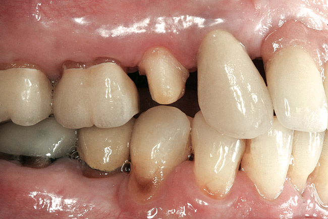 Zirconia Crown Prep