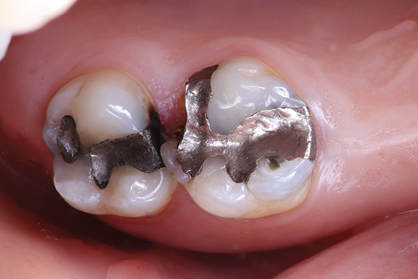 Amalgam Replacement Using Composite Core Buildup | August 2018 | Inside ...