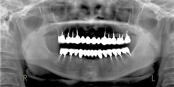 Severe Periodontitis Radiograph