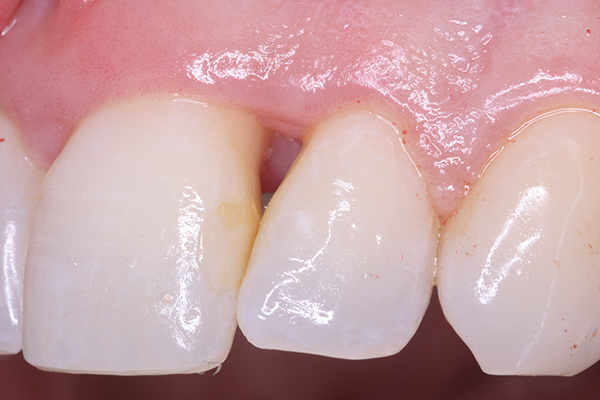 Restoration of Lost Interdental Papilla: A Surgical Technique ...