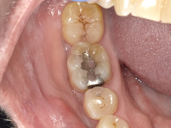 Increasing the Predictability of Class II Restorations | November 2018 ...