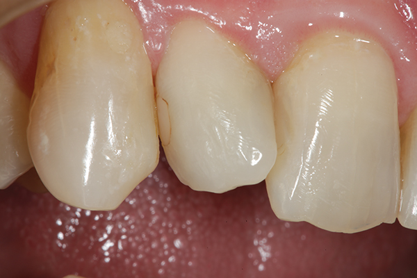 Class III Direct Restoration with Flowable Bulk-fill Composite ...