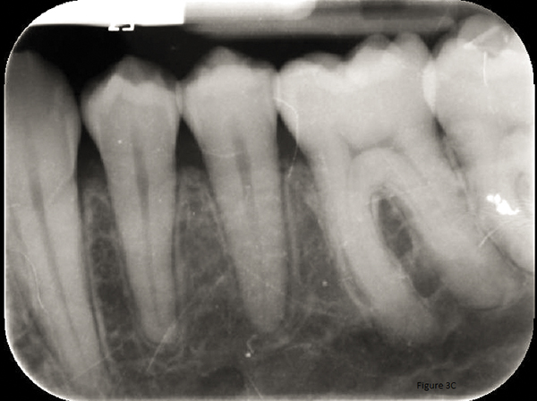 Periodontal Ligament Radiograph
