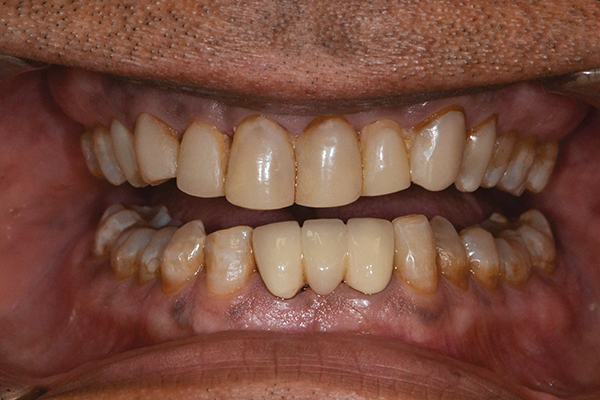 Transforming the Smile Line | May 2019 | Inside Dentistry