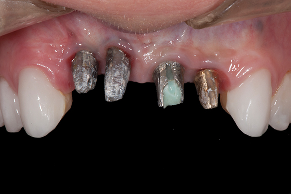 Werewolf Teeth Implants