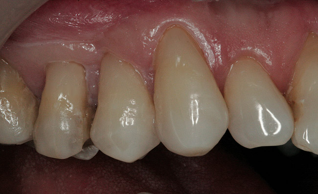 Tooth Abfraction Treatment