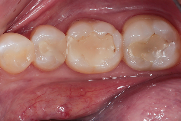 Recurrent Caries