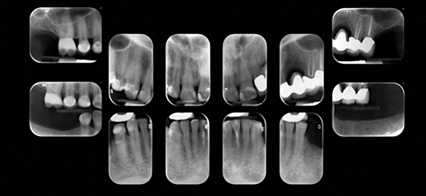 Retromolar Pad Radiograph