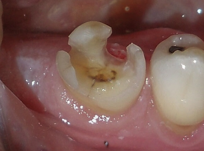 Effects Of Crack On Teeth