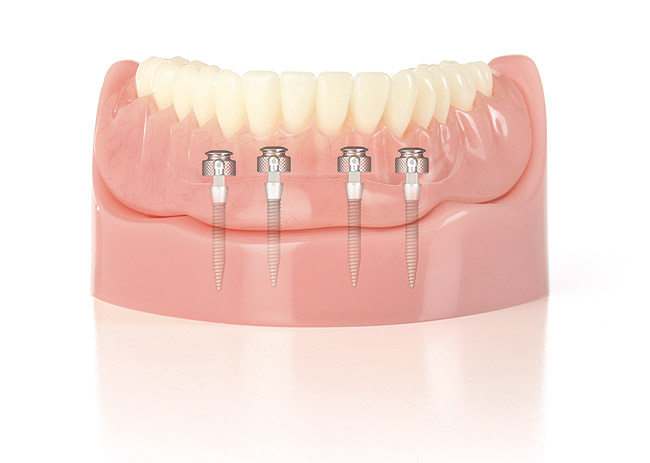 3M ESPE MDI Mini Dental Implants | November 2011 | Inside Dentistry