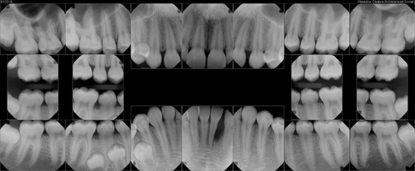 Severe Periodontitis Radiograph