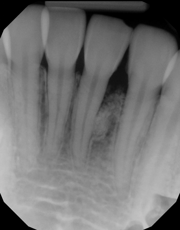 Severe Periodontitis Radiograph