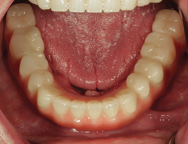 Healthy Bottom Teeth