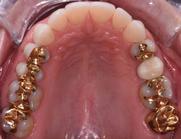 Gold Dental Fillings