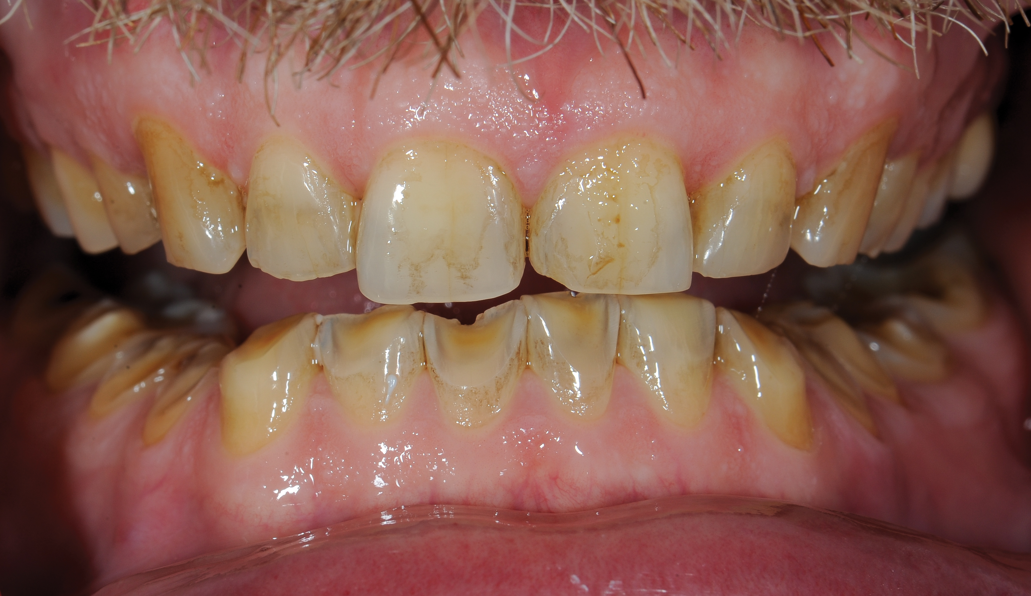 A Practical, Flowable Technique for Restoring a Worn Dentition ...