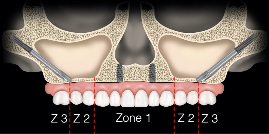Zygomatic Implants The Anatomy Guided Approach Product Review: