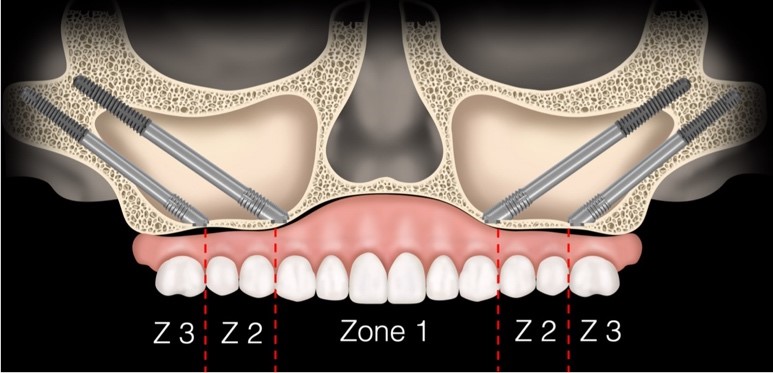 Maxillary Process Of Zygomatic Bone