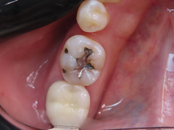 Amalgam Replacement Using a Universal Composite | September 2021 ...