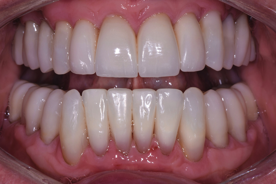 Updates in Direct Restorative