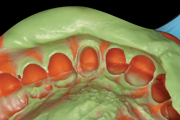 Coltene AFFINIS Materials Make Traditional Impression-Taking “Hassle ...