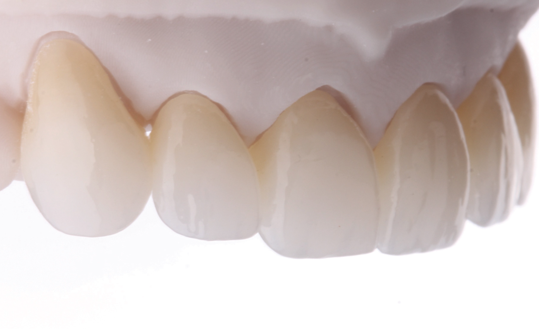 Improving Anterior Esthetics with All-Ceramic Restorations | March 2022 ...