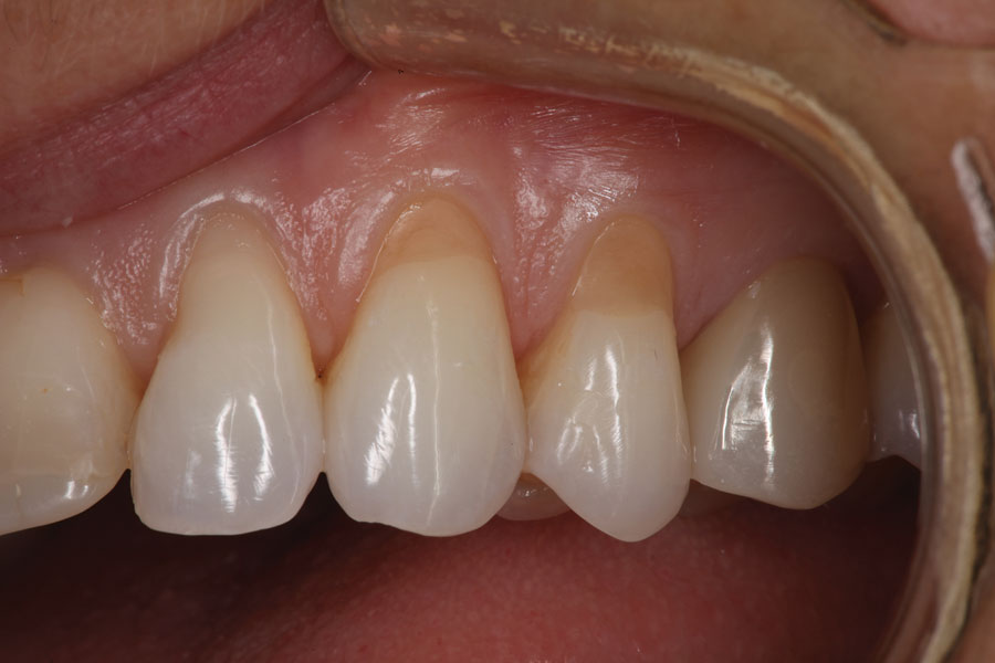 Treating Noncarious Class V Lesions With Composite Bonding | May 2022 ...