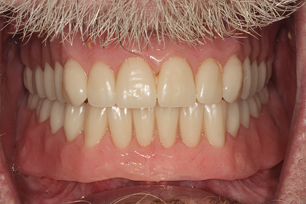 Adapting the Digital Reference Denture Technique for Full-Arch Cases ...