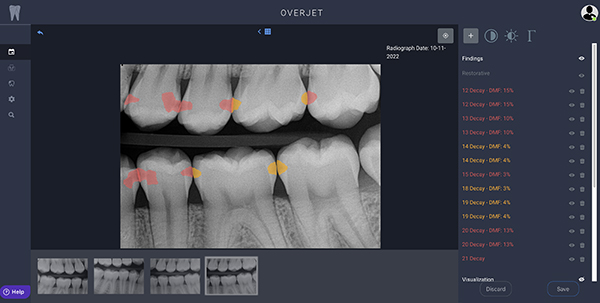 The Impact of Dental Artificial Intelligence for Radiograph Analysis ...