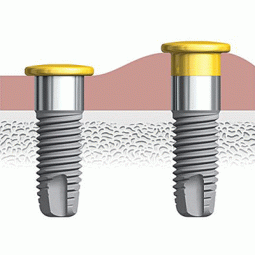Replace Select TC | Inside Dentistry