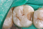 Caries Removal Using Polymer Burs | Inside Dentistry